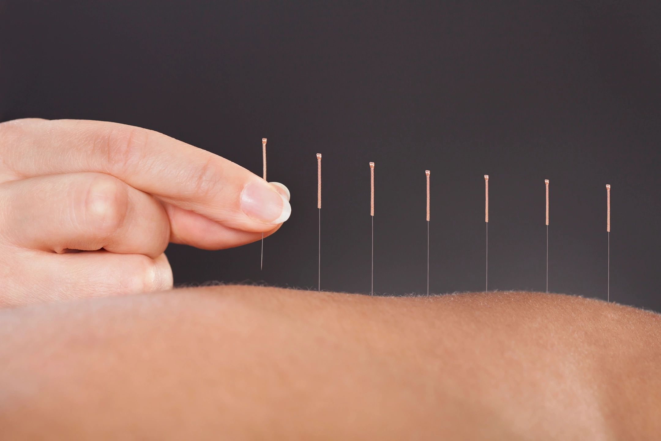 What is Acupuncture and how does it work? - Acupuncture & Holistic ...